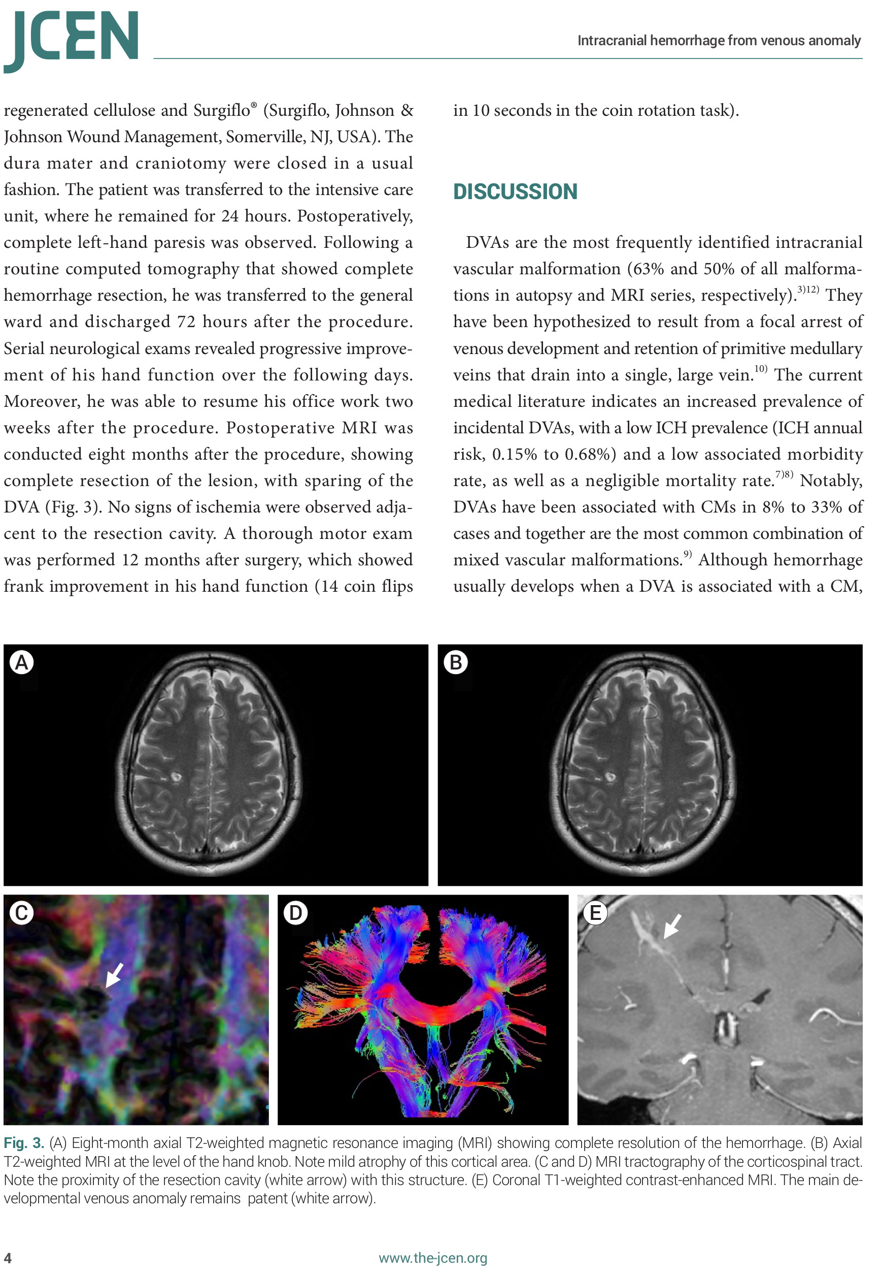 Awake craniotomy removal of a corticospinal tract developmental venous anomaly hemorrhage: A ...